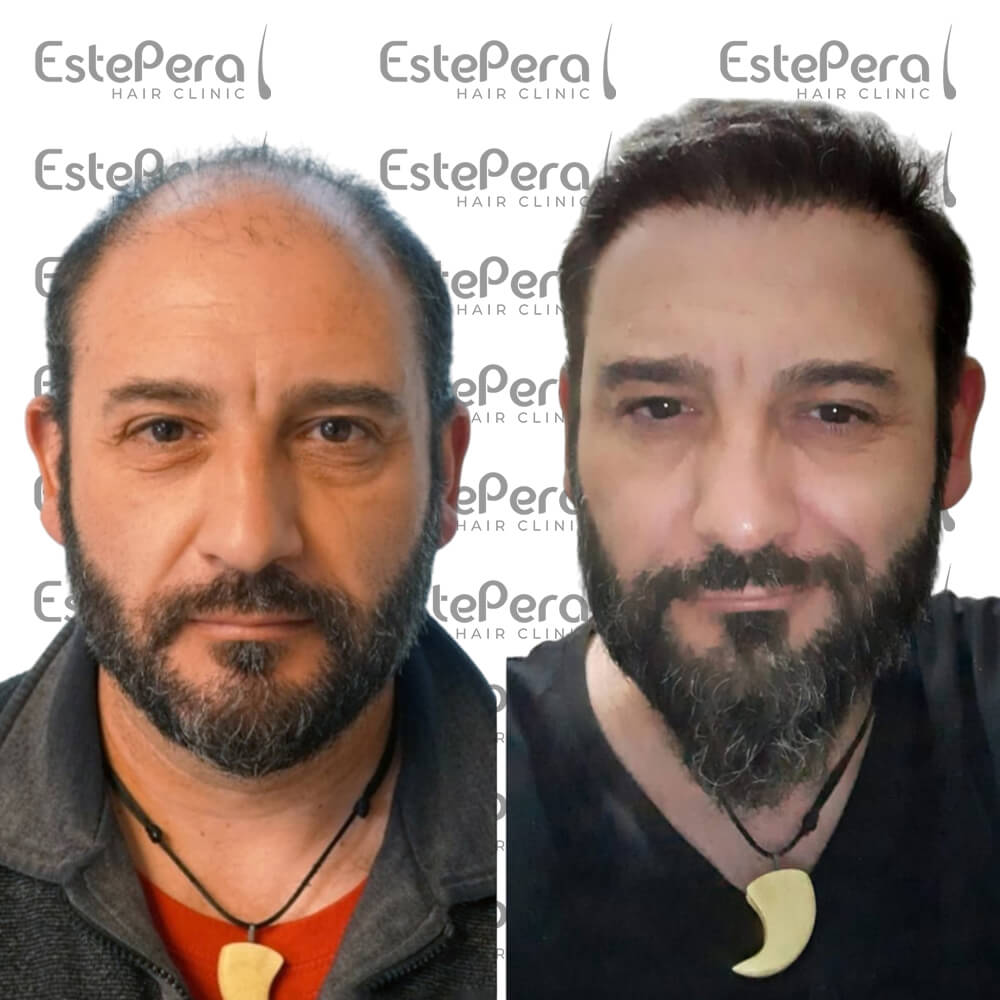 Trasplante De Barba Turquía - Estanbul | Estepera