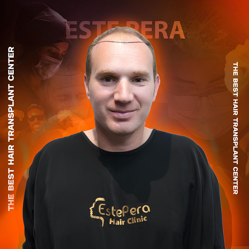 ¿La Cera Para el Cabello Daña tu Cabello | Estepera Hair Clinic