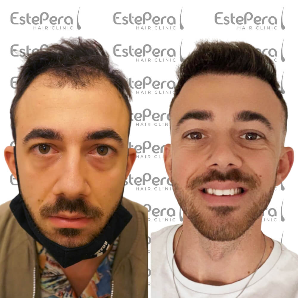 Trapianto Capelli Turchia, Istanbul | Clinica Estepera