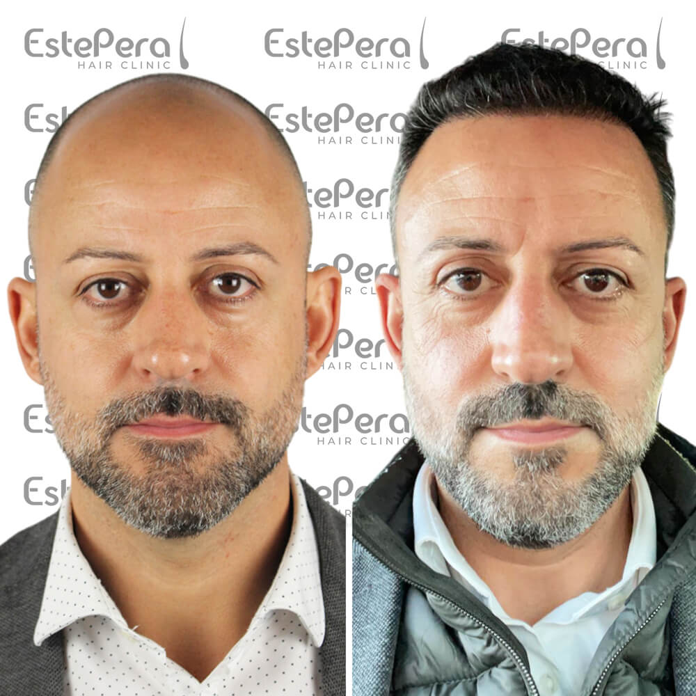 Trapianto Capelli Turchia, Istanbul | Clinica Estepera
