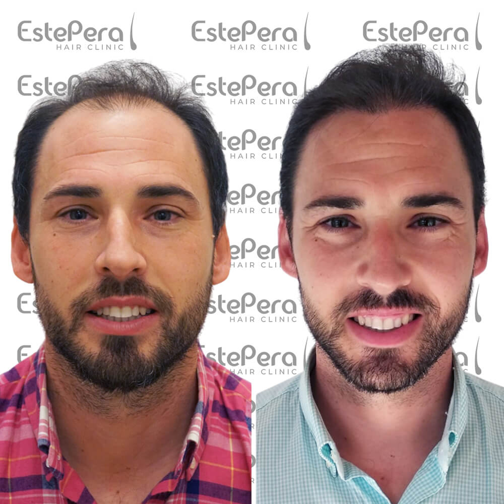 Trapianto Capelli Turchia, Istanbul | Clinica Estepera