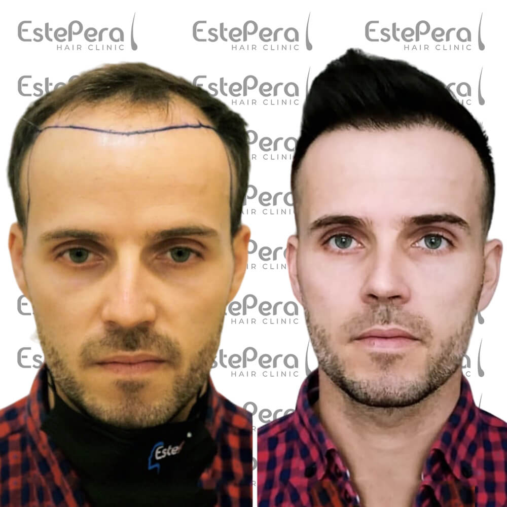 Trapianto Capelli Turchia, Istanbul | Clinica Estepera