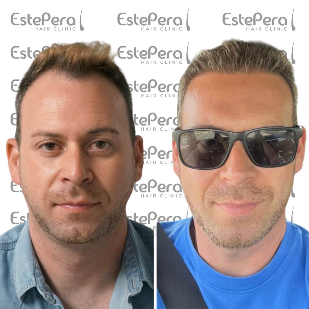 Trapianto Capelli Turchia, Istanbul | Clinica Estepera