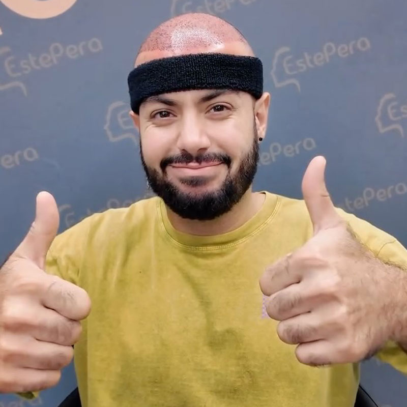 Tipos de linha capilar para homens e mulheres | Estepera Hair Clinic