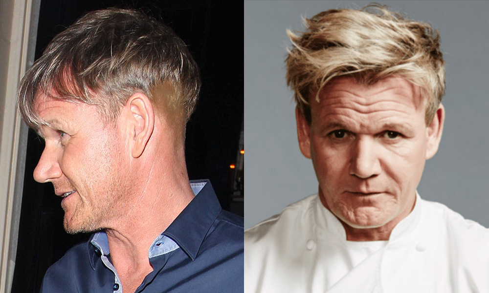 Celebrities With Hair Transplant- AJ McLean, Steve Carell etc ...