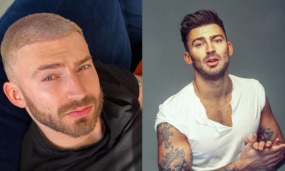 Celebrities With Hair Transplant- AJ McLean, Steve Carell etc ...