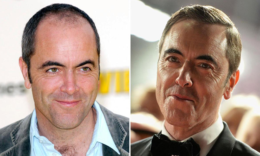 Celebrities With Hair Transplant- AJ McLean, Steve Carell etc ...