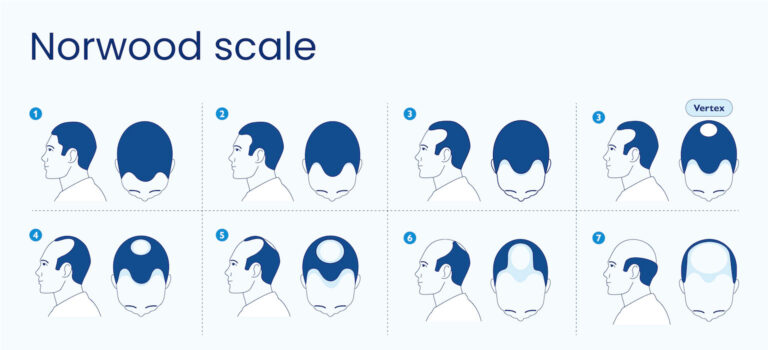 What is the Norwood Scale? | Estepera Hair Clinic
